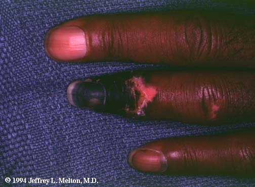 Auto Amputation of Digit (3)