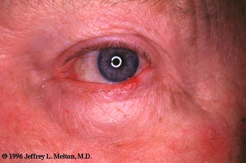 Stye of the Lower Eyelid