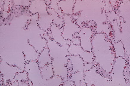 Emphysema