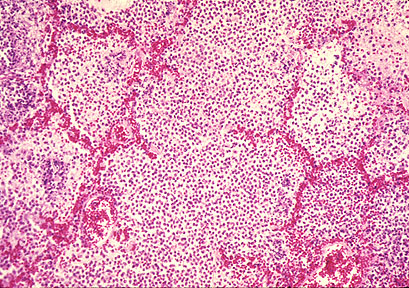 Lobar Pneumonia