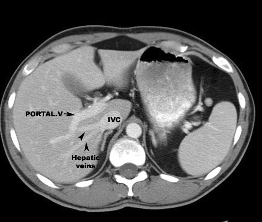 Hepatic Veins enter IVC just below the diaphragm