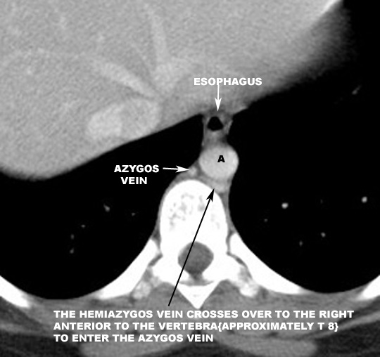 Inferior Vena Cava