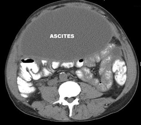 Large loculated ascites low density collection, displacing bowel ...