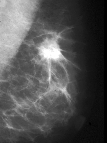 Spiculated mass in upper breast indicating infiltrative ductal carcinoma.