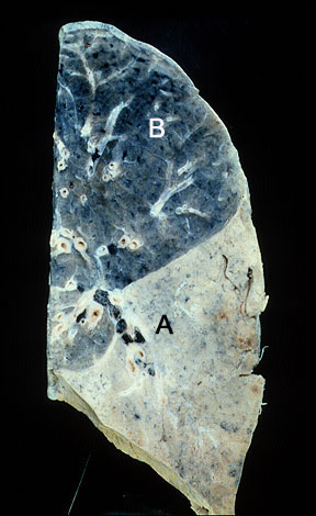 The lung shows acute inflammation. Lobe is consolidated Alveoli are ...