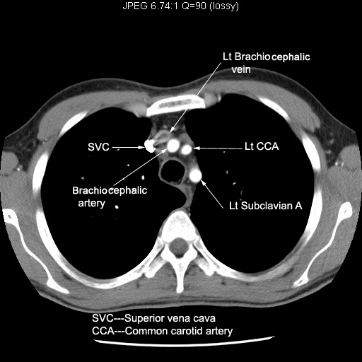 Subclavian Artery