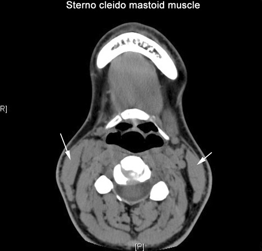 identify the sternocleido mastoid muscles click the image for labeling