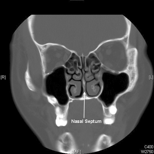 identify the nasal septum click the image for labeling