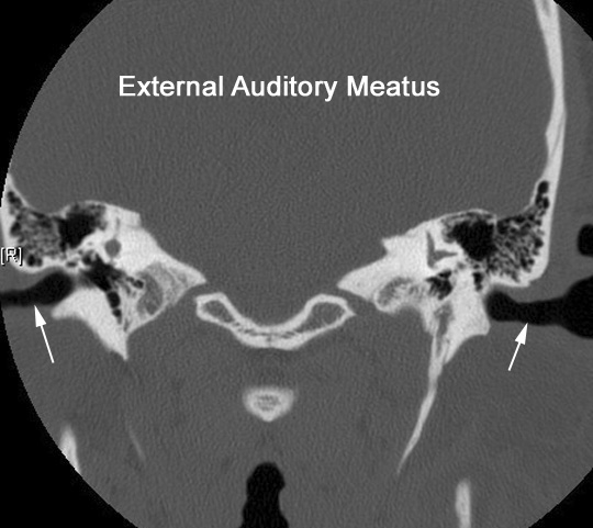identify the external auditory meatus click the image for labeling