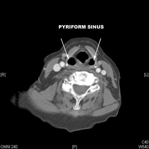 identify pyriform sinus
