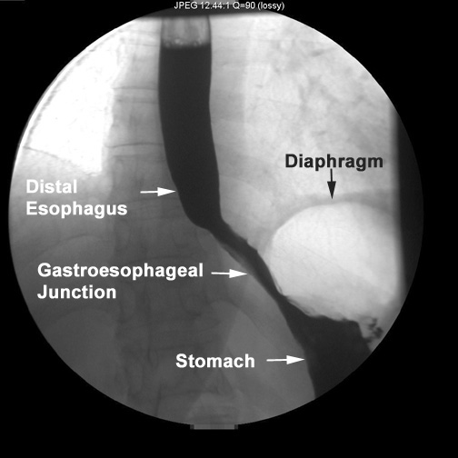 The human esophagus is about 10 in
