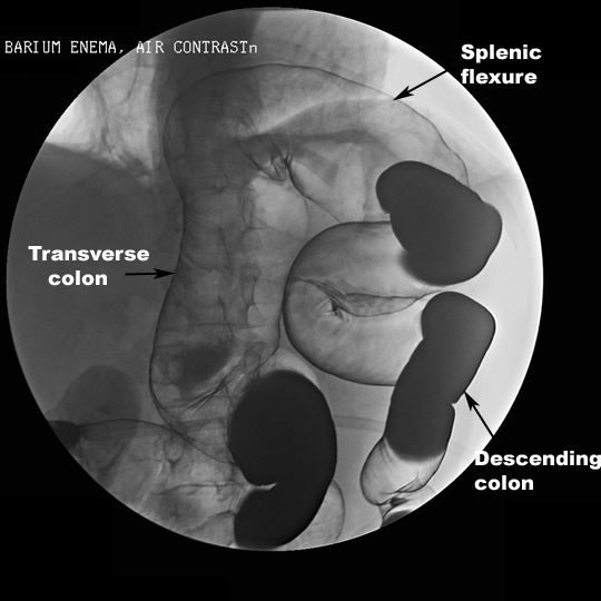 Course of Esophagus