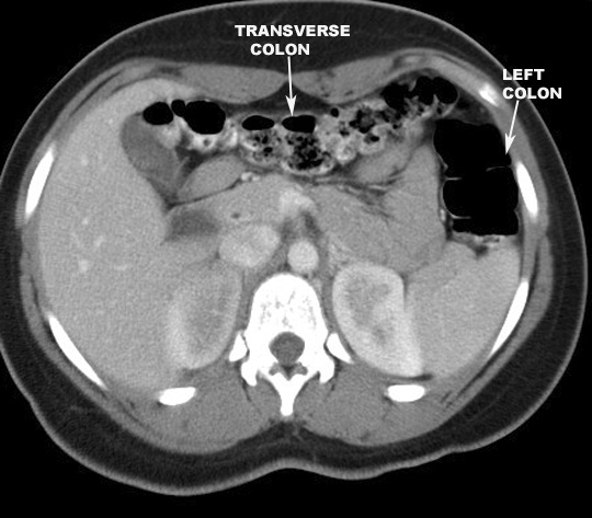 The human esophagus is about 10 in