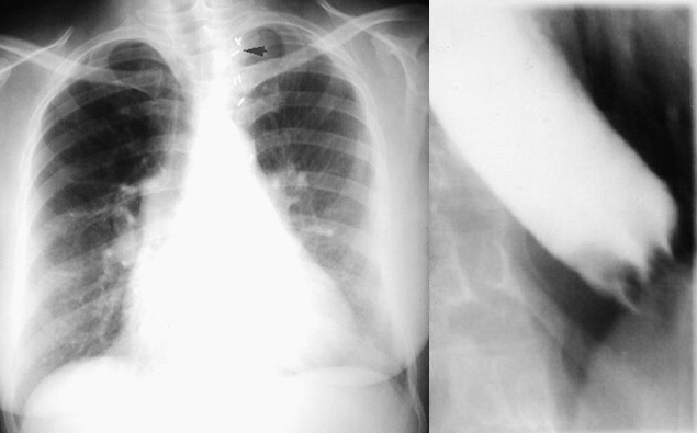 There can be significant interstitial disease with a normal CXR as seen ...