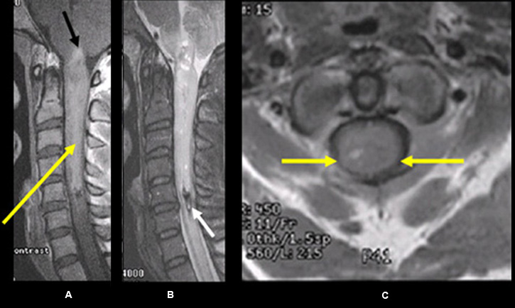 Cervical Spine Mri Tumor