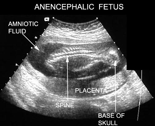 Anencephaly