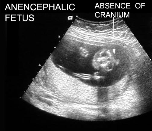 Anencephaly