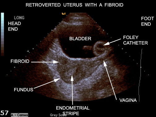US: Fibroid