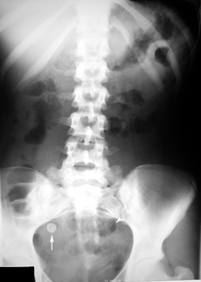 Sentinel Loop Appendicitis
