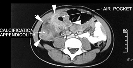 Acute Appendicitis Appendiceal abscess