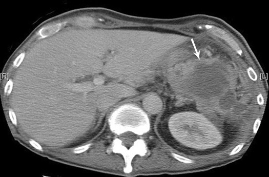 Subdiaphragmatic abscess post splenectomy