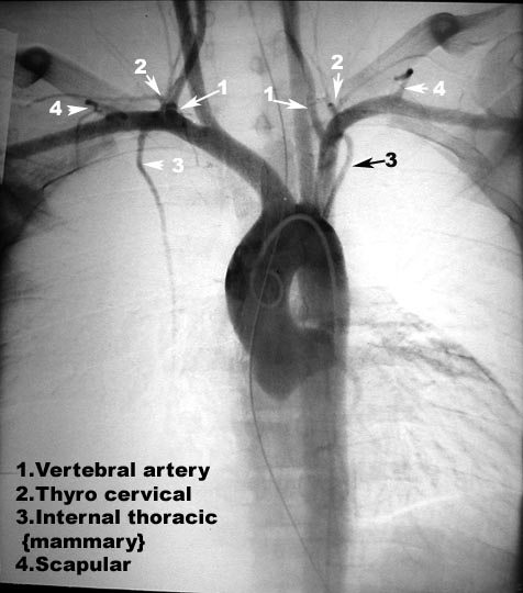 Subclavian Artery