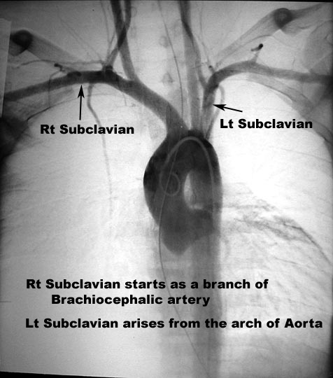 Angiogram: Branches of subclavian artery