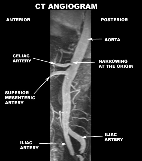 Lateral view Reconstructed image Celiac artery