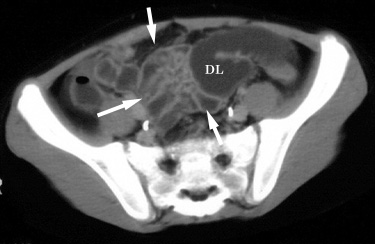 Postop Complications